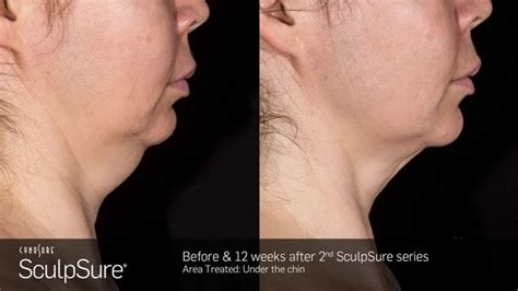 Sculpture Body Contouring Plastic Surgeon And Dermatologist In Fairfax Va