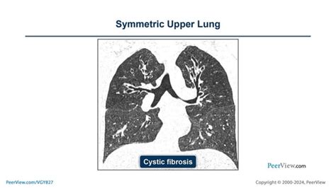 Bridging The Gap To Improved Outcomes In Non Cystic Fibrosis