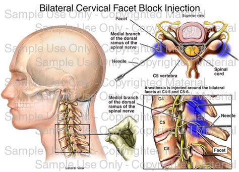 Facet Joint Nerve Block Injection Mapasgmaes