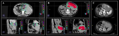 Advanced And Emerging Radiation Therapy Approaches For Intrahepatic