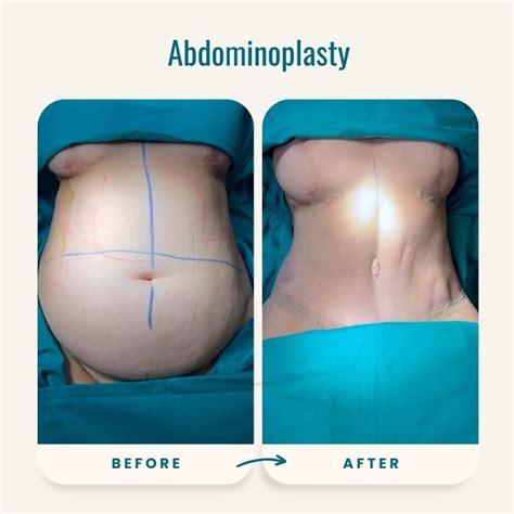 Abdominoplasty Tummy Tuck Imed Medical