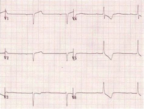 R Wave • Litfl • Ecg Library Basics