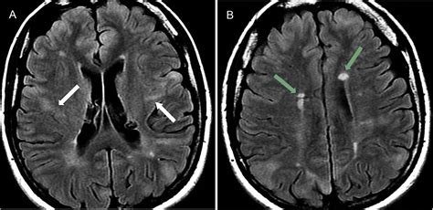 Epilepsy Brain Mri