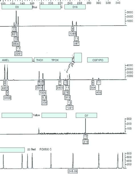 Sperm Fraction Electropherogram From Victims Vaginal Swab After