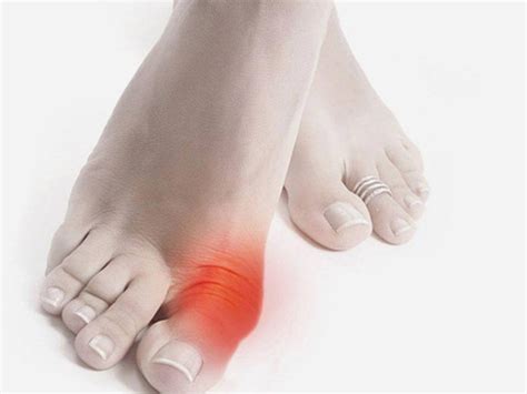 Methods For Diagnosing Gout Alkyloverstrung