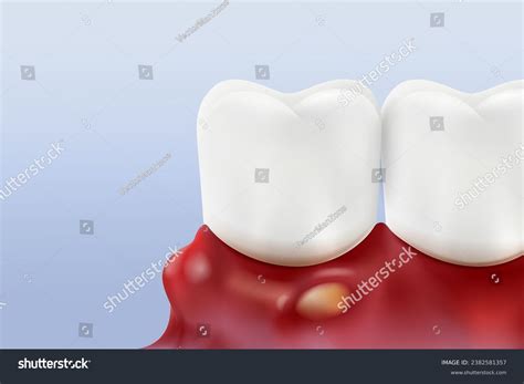 Gingivitis Swollen Gums That Form Pustules Stock Vector Royalty Free 2382581357 Shutterstock