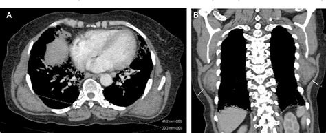 Table 1 From Prevalence Of Elastofibroma Dorsi On Ct Is It Really An