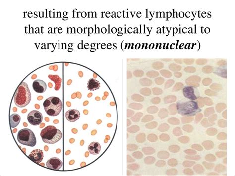 The Diseases With Tonsilitis Diphtheria And Infectious Mononucleosis