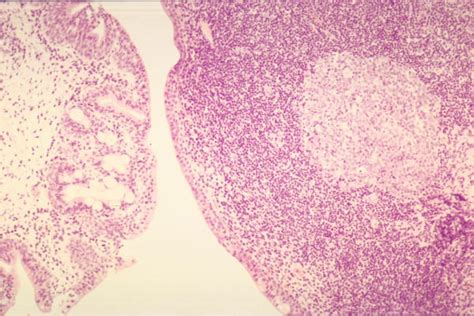 Bladder Biopsy Tests And Diagnostics Onewelbeck Womens Health