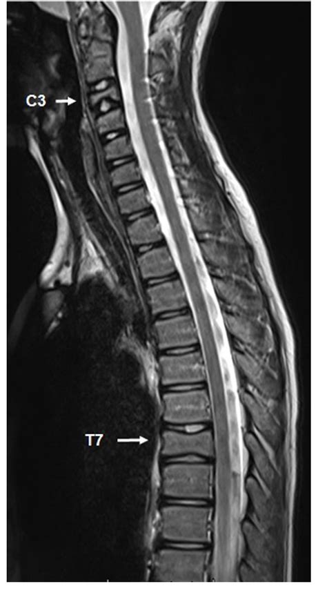 Figure 5 From Eosinophilic Granuloma Of The Spine Involving C1 And