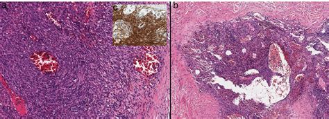 Kaposi Sarcoma Skin Histology
