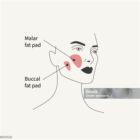 Ilustración De Eliminación De La Almohadilla De Grasa Malar Y La