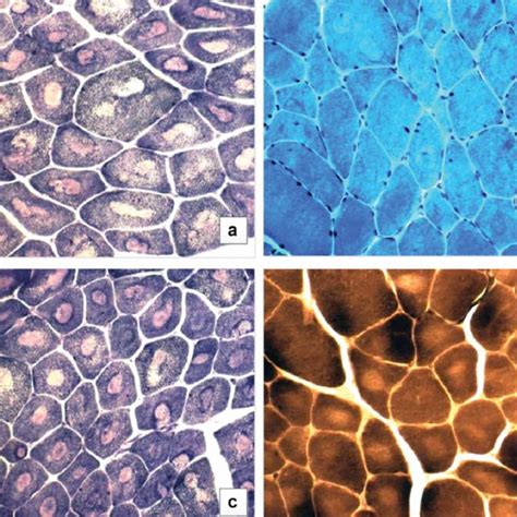 Central Core Disease Presence Of Cores On Nadh Staining Ac On