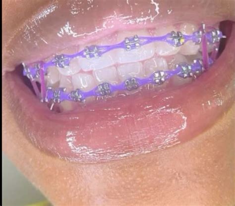 Purple Chain Braces Purple On Braces Pink Chain Braces Braces Inspo