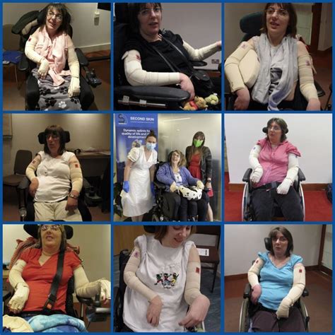 Living With Cerebral Palsy How Second Skin Splints Help Kingsway Care