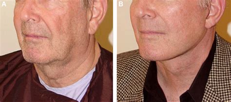 Male Facelift Clinics In Plastic Surgery