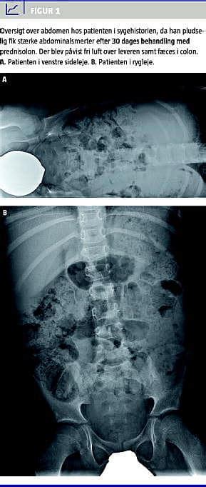 Udvikling Af Perforeret Ulcus Ventriculi Under Højdosisprednisolon I