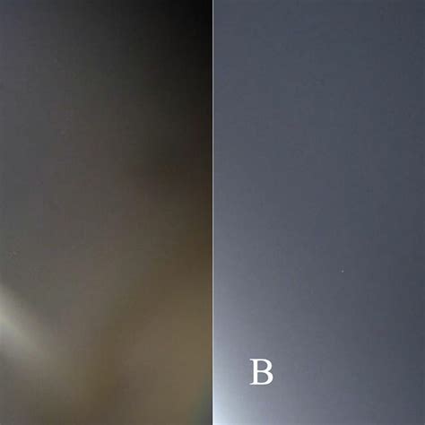 Technical Drawing Of The Glaucoma Stent The Stent Represents A
