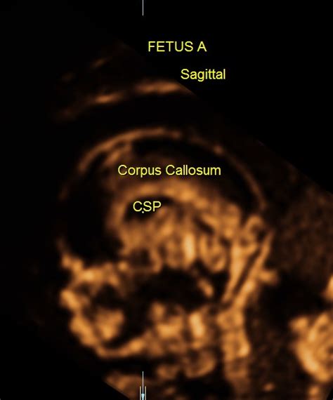 Mono Chorionic Di Amniotic Twin Pregnancy With Anencephaly Of One