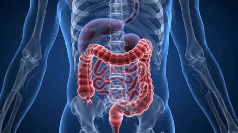 Medical Illustration Of A Blocked Intestine With A Calcified Mass
