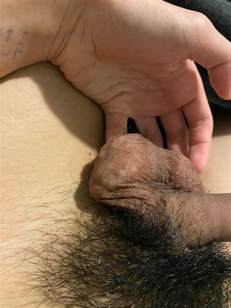 Varicocele Laparoscopic Surgery Second Time After First One Fail R Varicocele