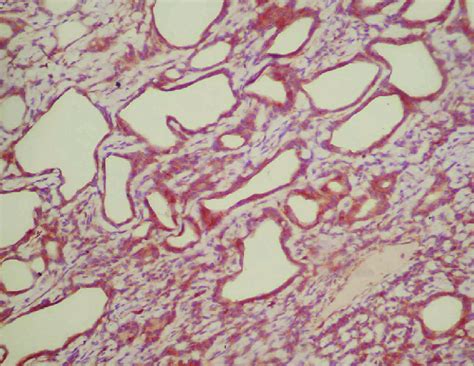 The Expression Of Mca To Human Papilloma Virus Type 16 In Pleomorphic