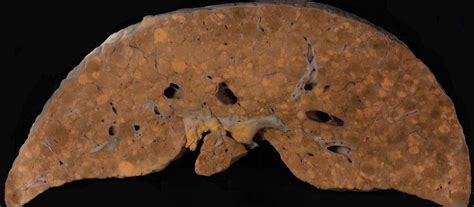 Liver Cirrhosis Pathology