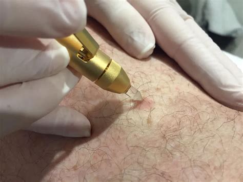 Cryo Therapy Wart Treatment Wart Removal Treatments