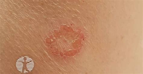 Discoid Eczema Day 13 Image