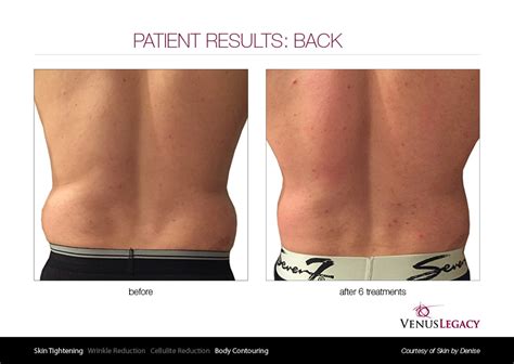 Perth Medical Cosmetic Clinic Face And Body Sculpting Venus Legacy Perth