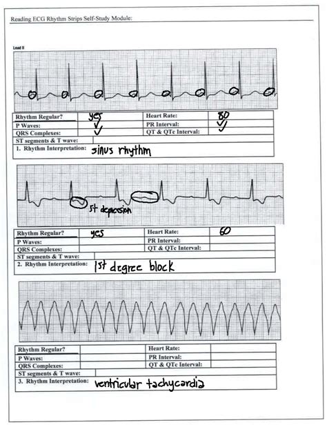 Ekg Practice Rhythm Analysis And Arrhythmia Overview Studocu