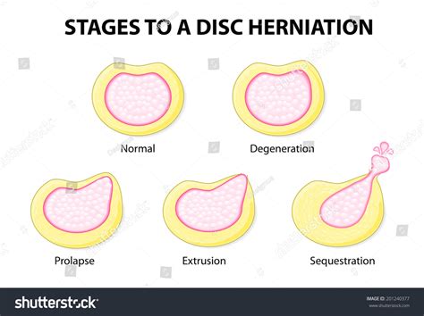 183 Imagens De Disc Extrusion Imagens Fotos Stock E Vetores Shutterstock