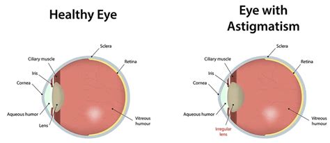 How Does Astigmatism Affect Vision Pure Optical
