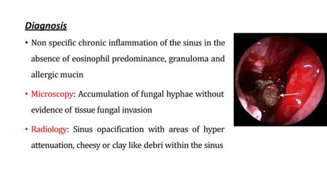 Fungal Sinusitispptx Ear Nose And Throat Conditions Diseases And
