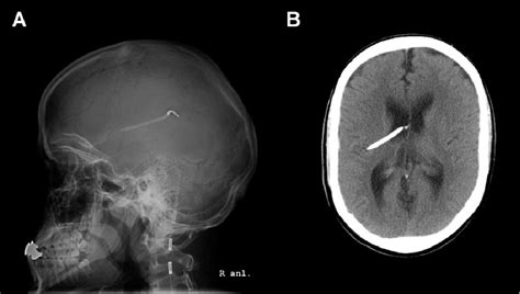 Figure 1 From Radiological Evaluation Of Ventriculoperitoneal Shunt