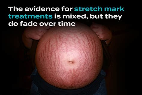 Stretch Marks Men
