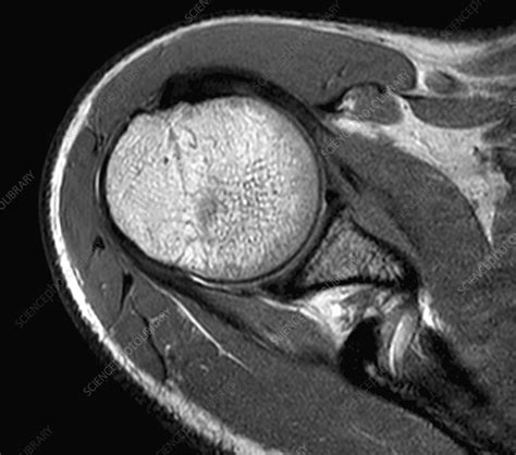 Healthy Shoulder Joint Mri Scan Stock Image C048 9209 Science