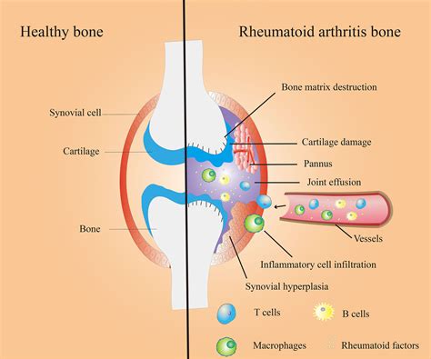 Juvenile Rheumatoid Arthritis Joint Damage Inflammatory Arthritis Care