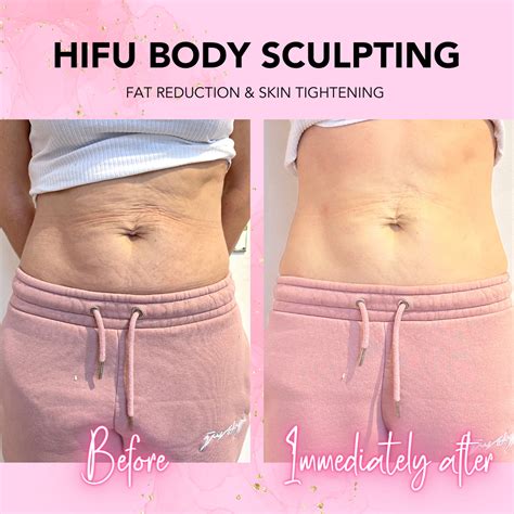 Hifu Skin Tightening Rejuvenate Now Book Today — Bodylicious