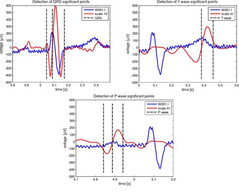 Figure 2 From A Wavelet Based Ecg Delineation With Improved P Wave