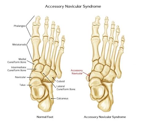 Os Naviculare Wikism Sports Medicine Wiki