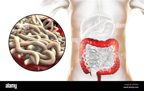Round Worms In Human Large Intestine Computer Artwork Roundworms Or