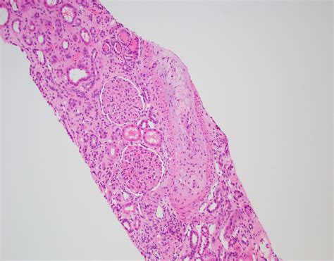 Pathology Outlines Scleroderma Renal Disease