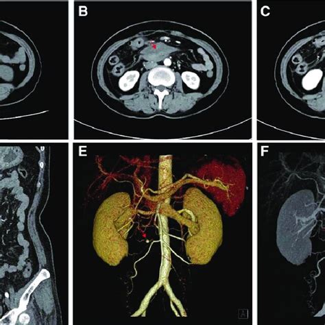A Nonenhanced Ct Shows A Mass In Front Of The Duodenum Under The Download Scientific Diagram