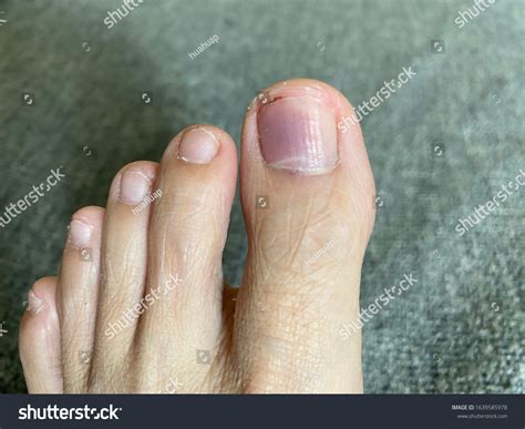 Subungual Hematoma Bleeding Under Toe Nail Foto Stock 1639585978