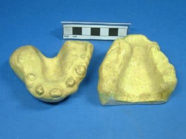 Casts Of The Teeth Of Julia Pastrana 1834 1860 A Unique Display At