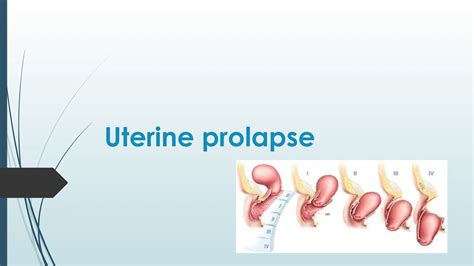 Uterine Prolapse With Definition Stagesmanagement Pptx