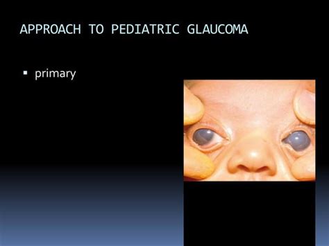 Approach To Pediatric Glaucoma Pptx Eye And Vision Conditions
