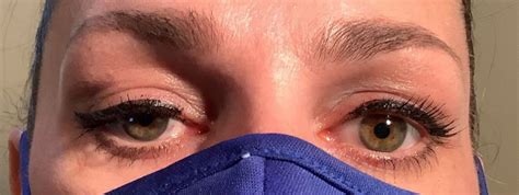 External Levator Advancement Beach Eye Care Lasik And Vision