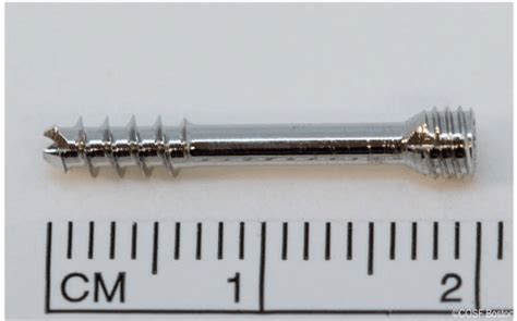Scaphoid Fractures Musculoskeletal Key